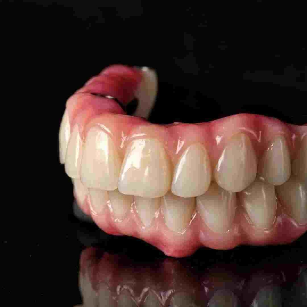 ALL-ON-4-Therapie – Perfekte feste Zähne